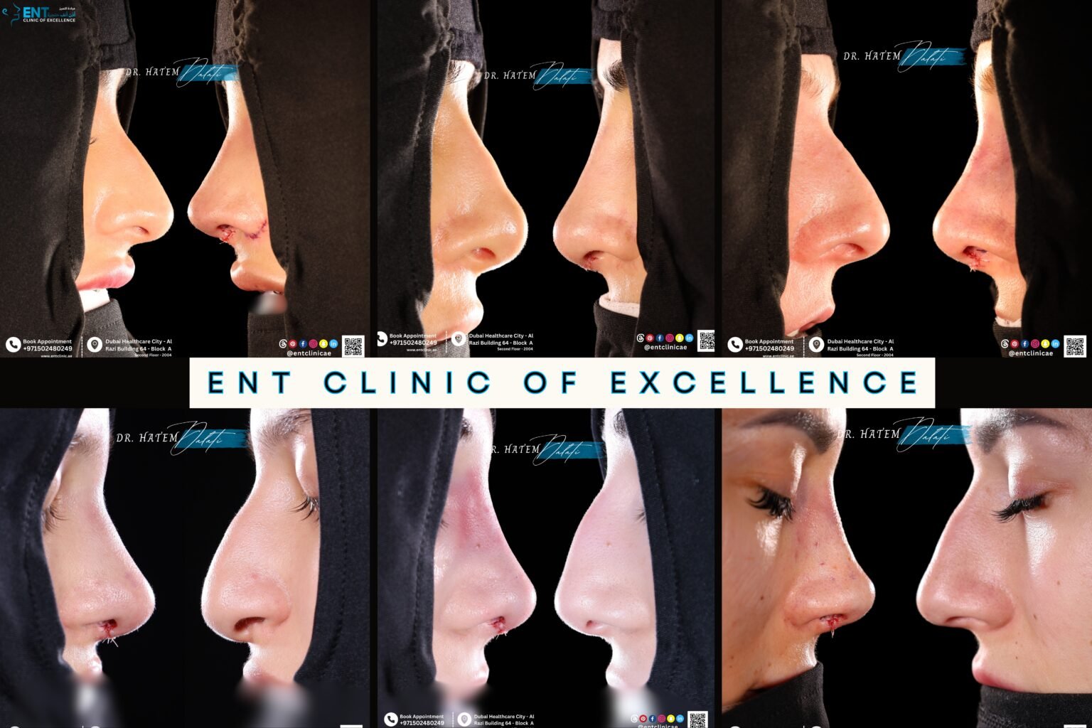 How to Maintain Your Rhinoplasty Results for Years 👃 | Expert Tips from ...